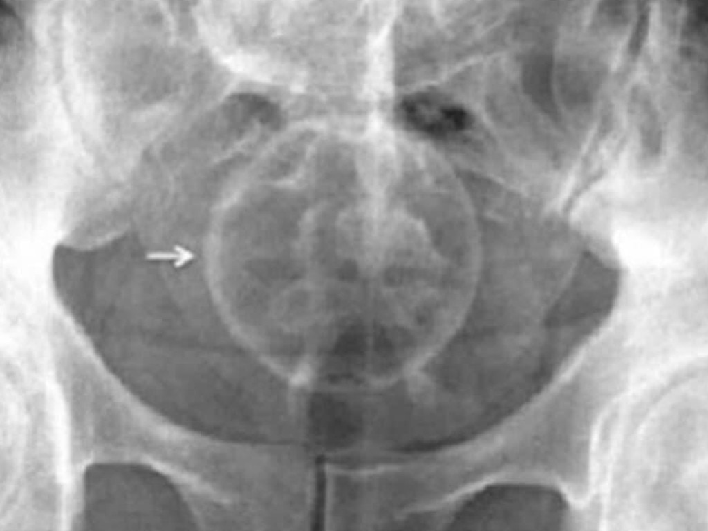Masturbating With Christmas Ornaments X Rays Expose ‘stupid Sex Trend