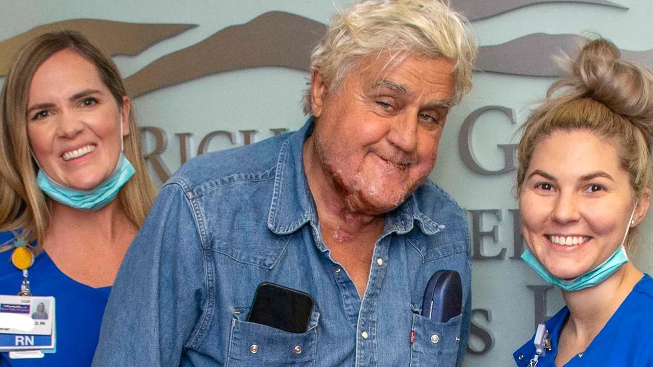 Jay Leno Suffers Injuries From Nasty Accident Gold Coast Bulletin