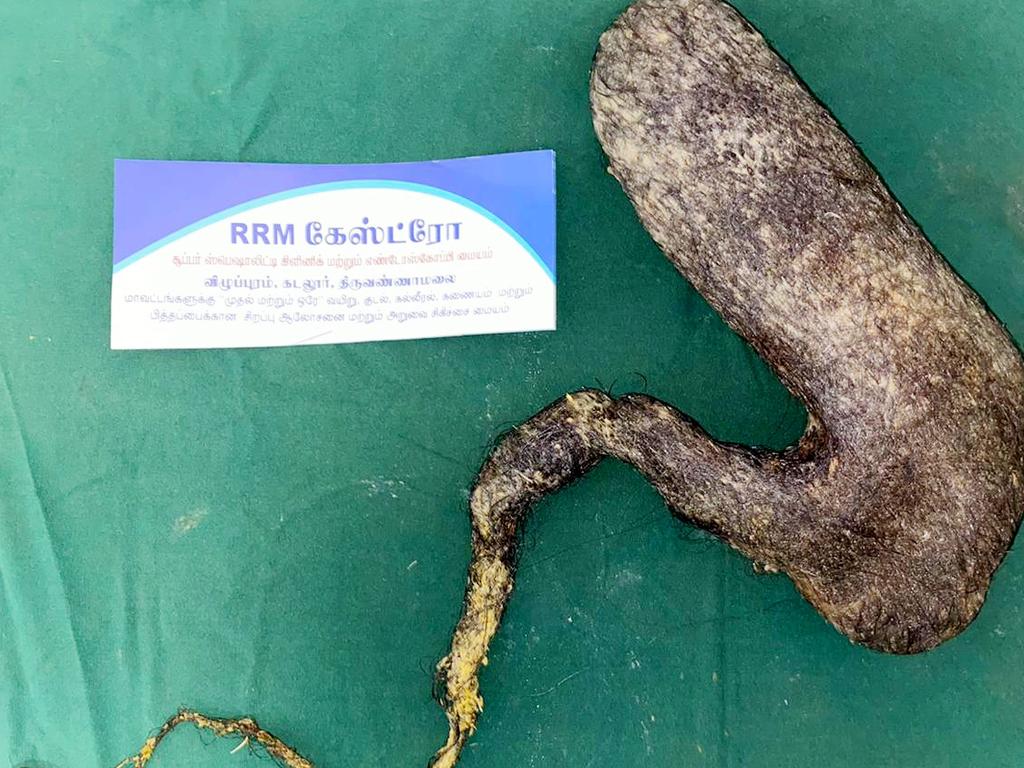 Girl With Rapunzel Syndrome Has 1 5kg Hairball Removed From Stomach
