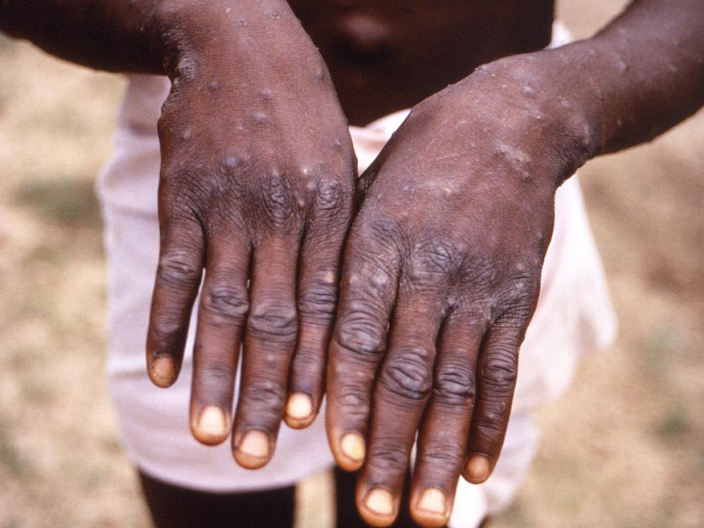 WA records second case of monkeypox virus | news.com.au — Australia’s ... WA records second case of monkeypox virus | news.com.au — Australia’s ...