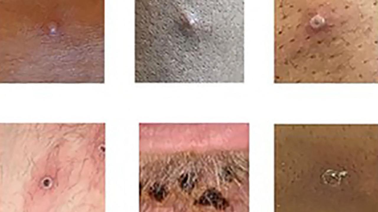 WA records second case of monkeypox virus | The Australian WA records second case of monkeypox virus | The Australian